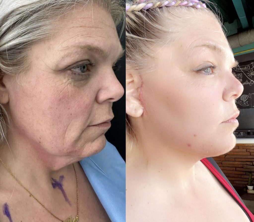 Face Lift - Plastica Tijuana